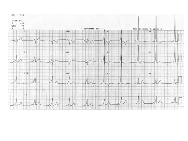 ECG markers in Sudden Cardiac Death