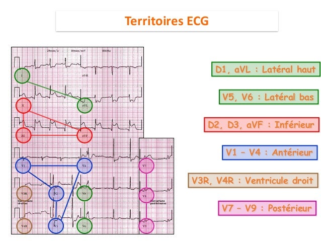 ECG du SCA - Diplôme Universitaire Urgences Vitales Paris VI