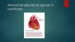 Heart Arrhythmia | PPT