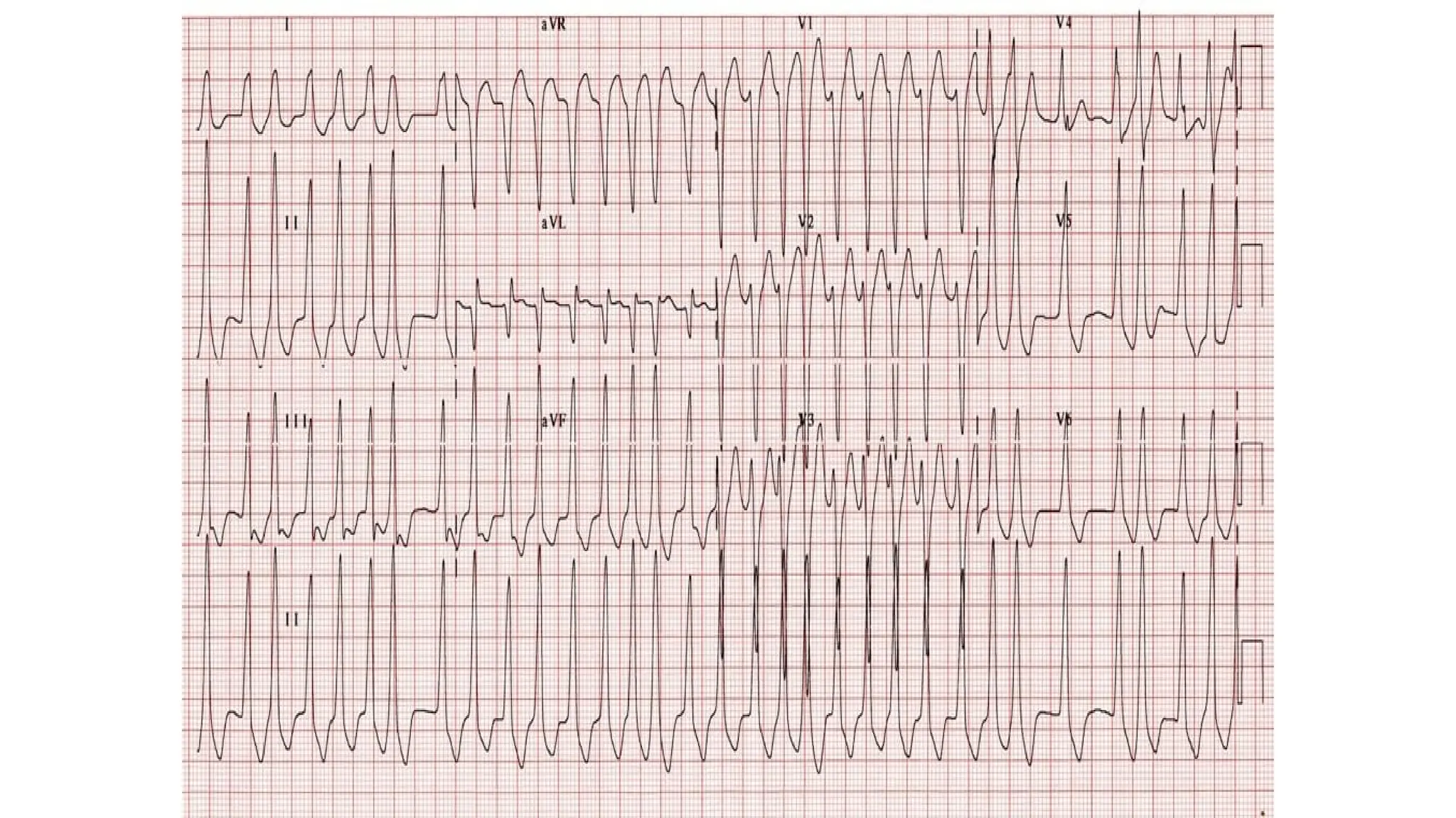 Ecgs for discussion in intensive care.pptx
