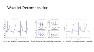 ECG Signal Analysis for Myocardial Infarction Detection | PPT