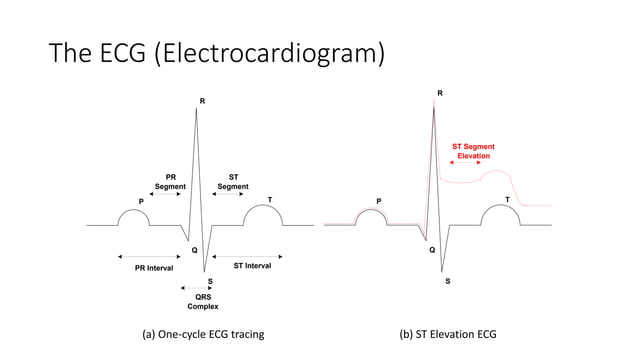 Ecg Signal Analysis For Myocardial Infarction Detection Ppt