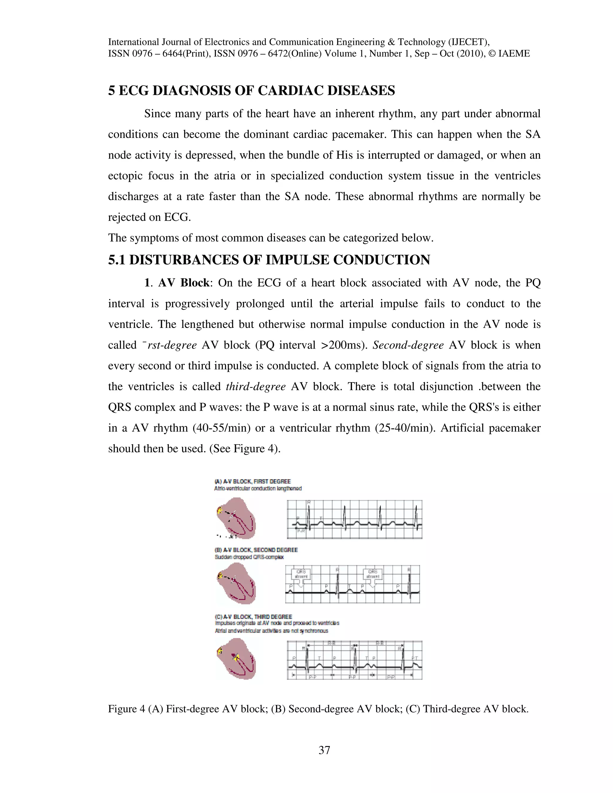 Ecg Signal Processing For Detection And Classification Of Cardiac