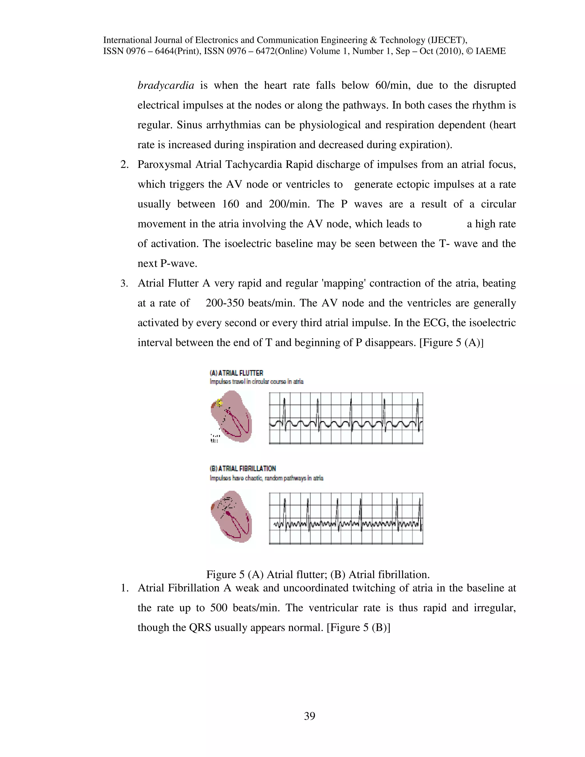 Ecg Signal Processing For Detection And Classification Of Cardiac