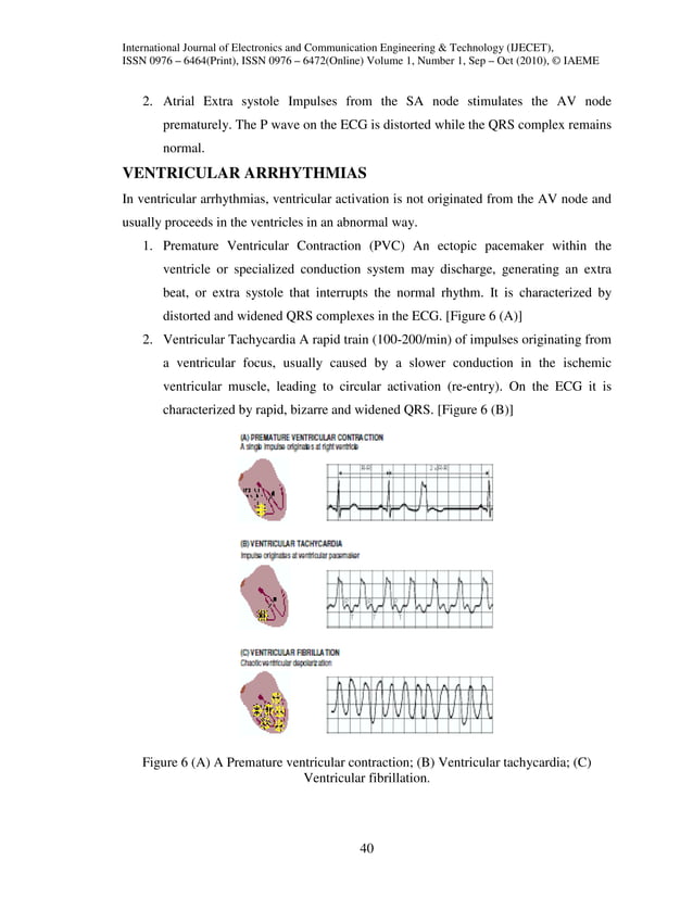 Ecg Signal Processing For Detection And Classification Of Cardiac