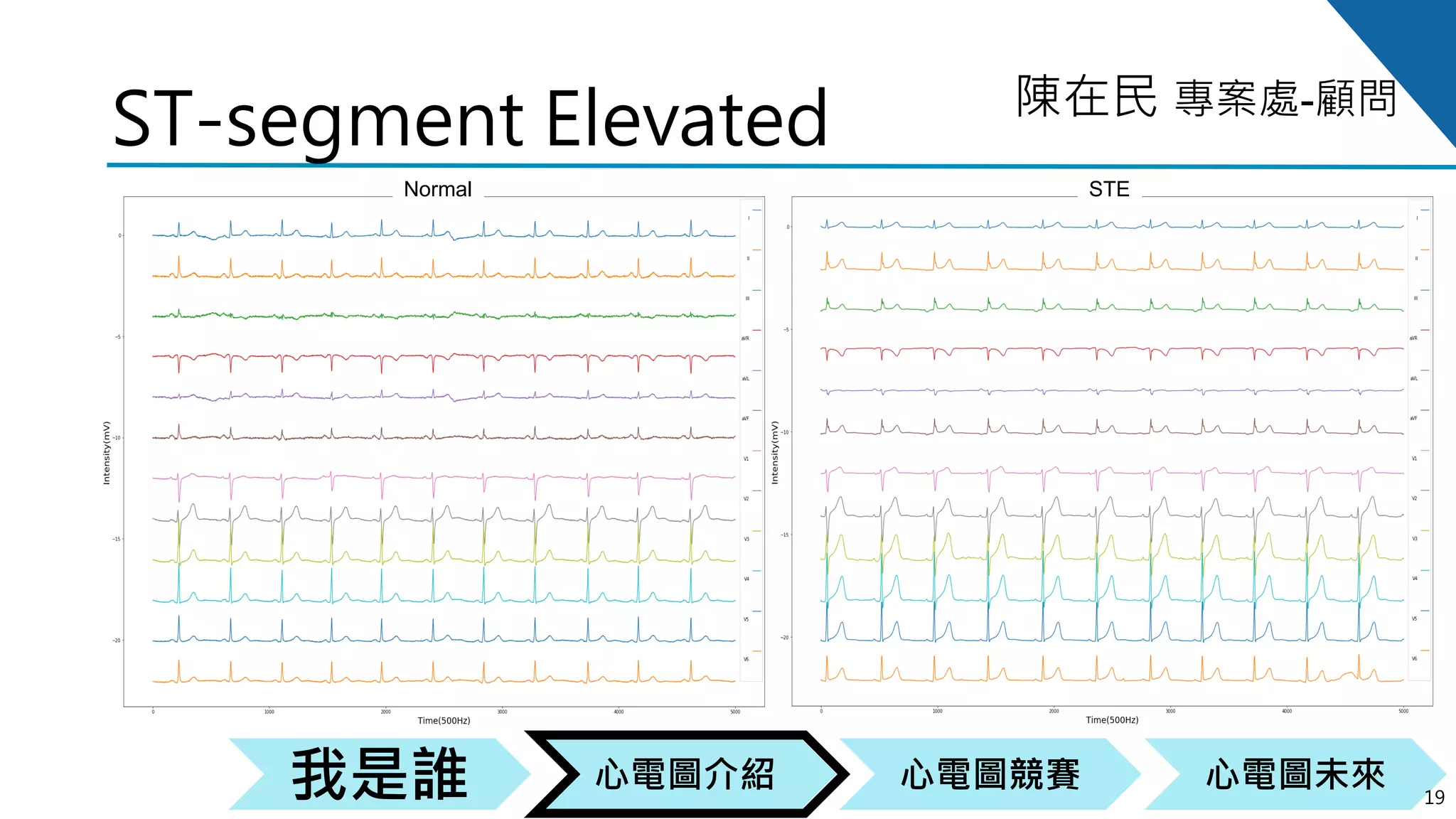 ECG Signal Processing for Heart Diseases Detection | PDF