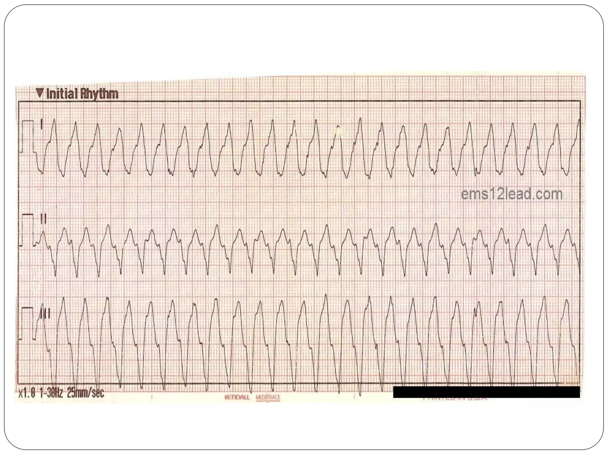 ECG Simple Approach.pptx