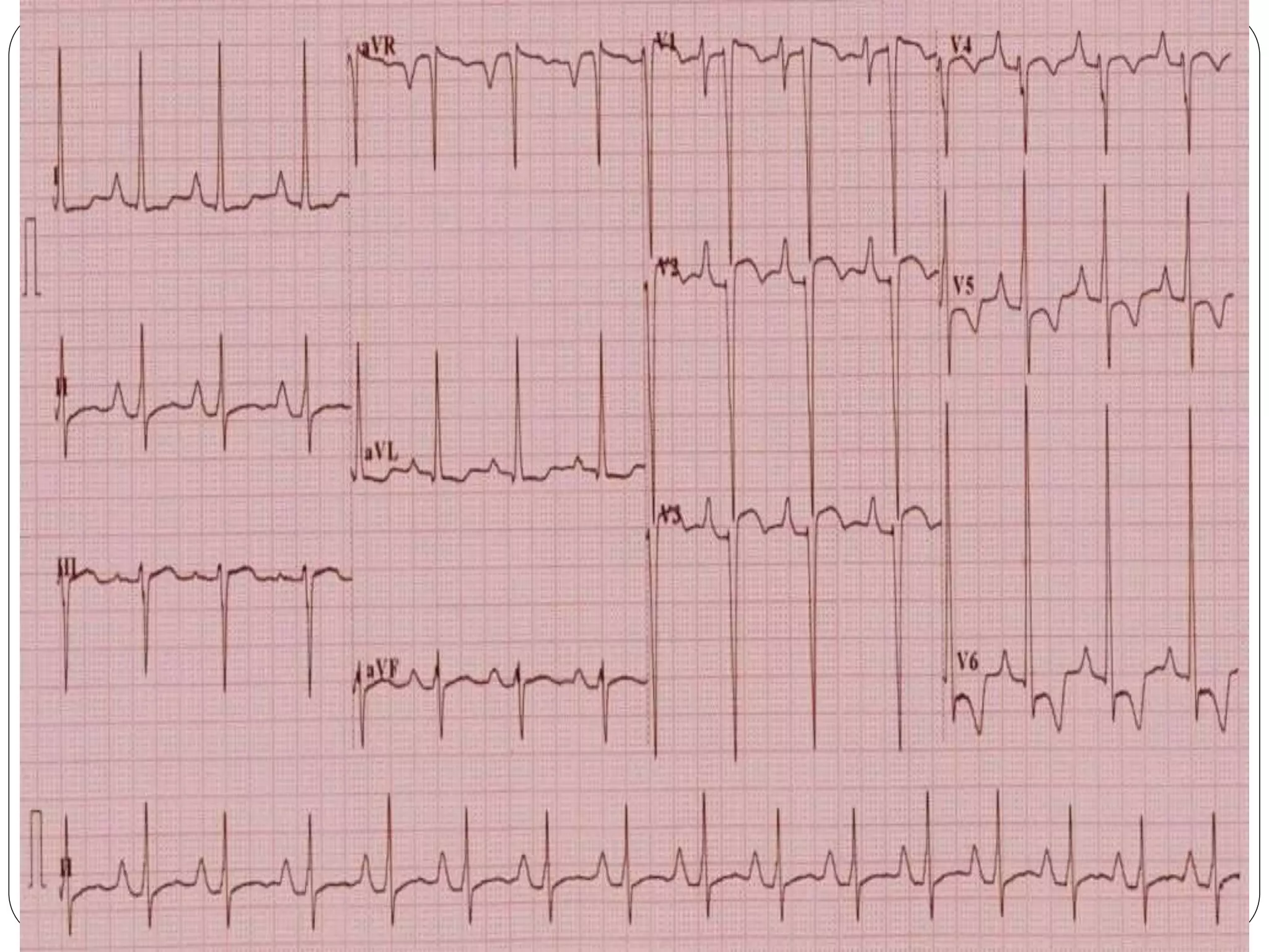 ECG Simple Approach.pptx