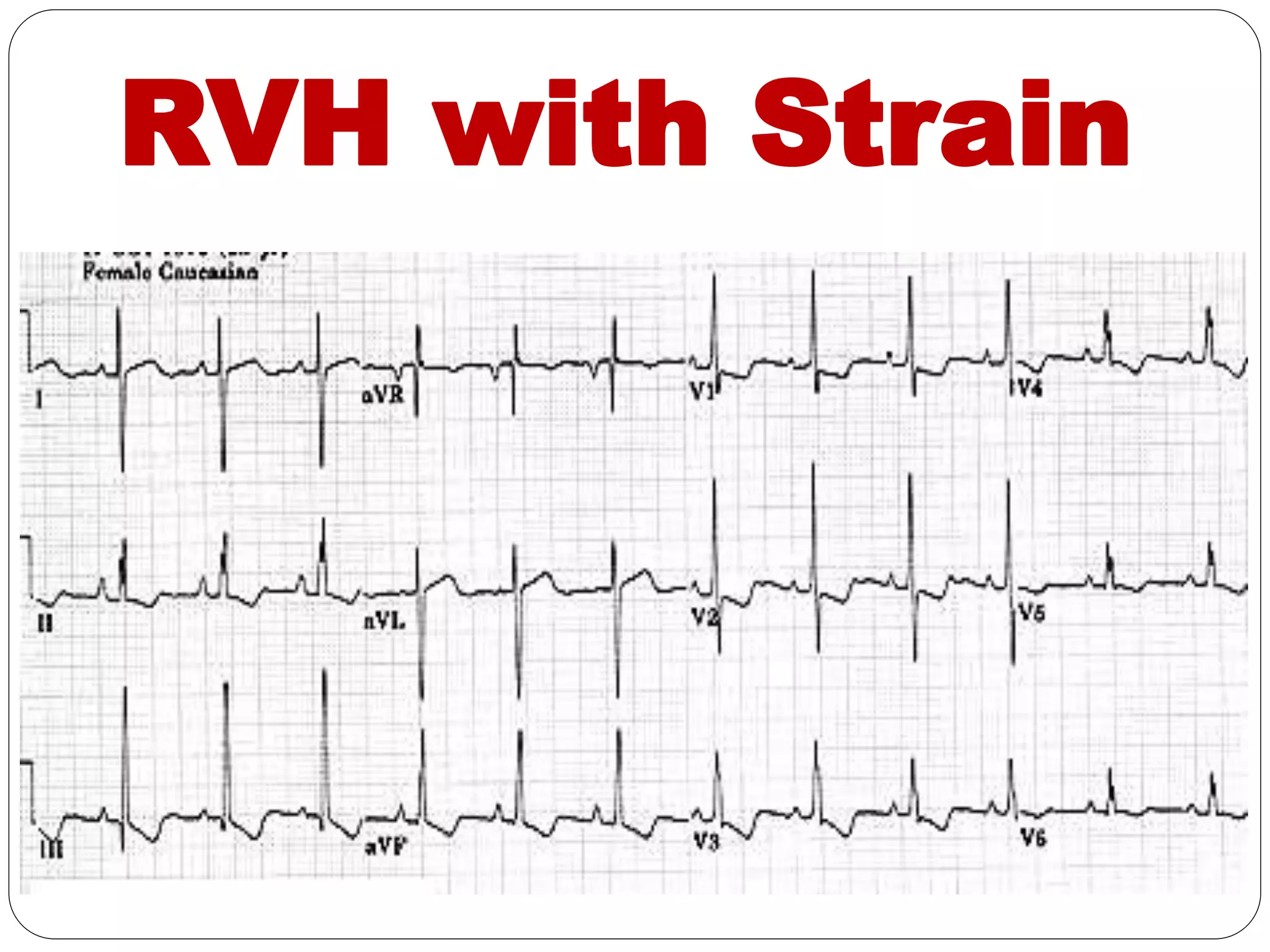 ECG Simple Approach.pptx