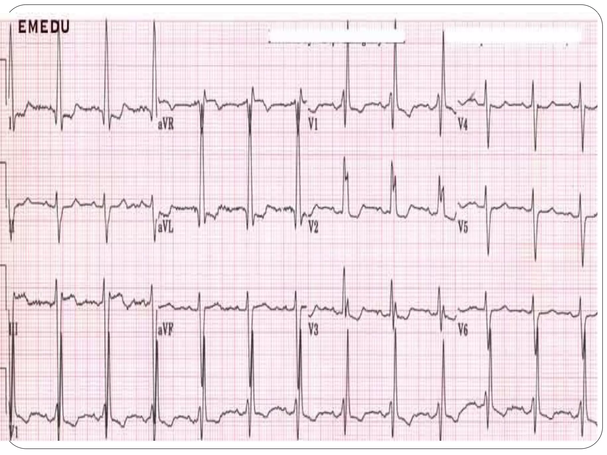 ECG Simple Approach.pptx