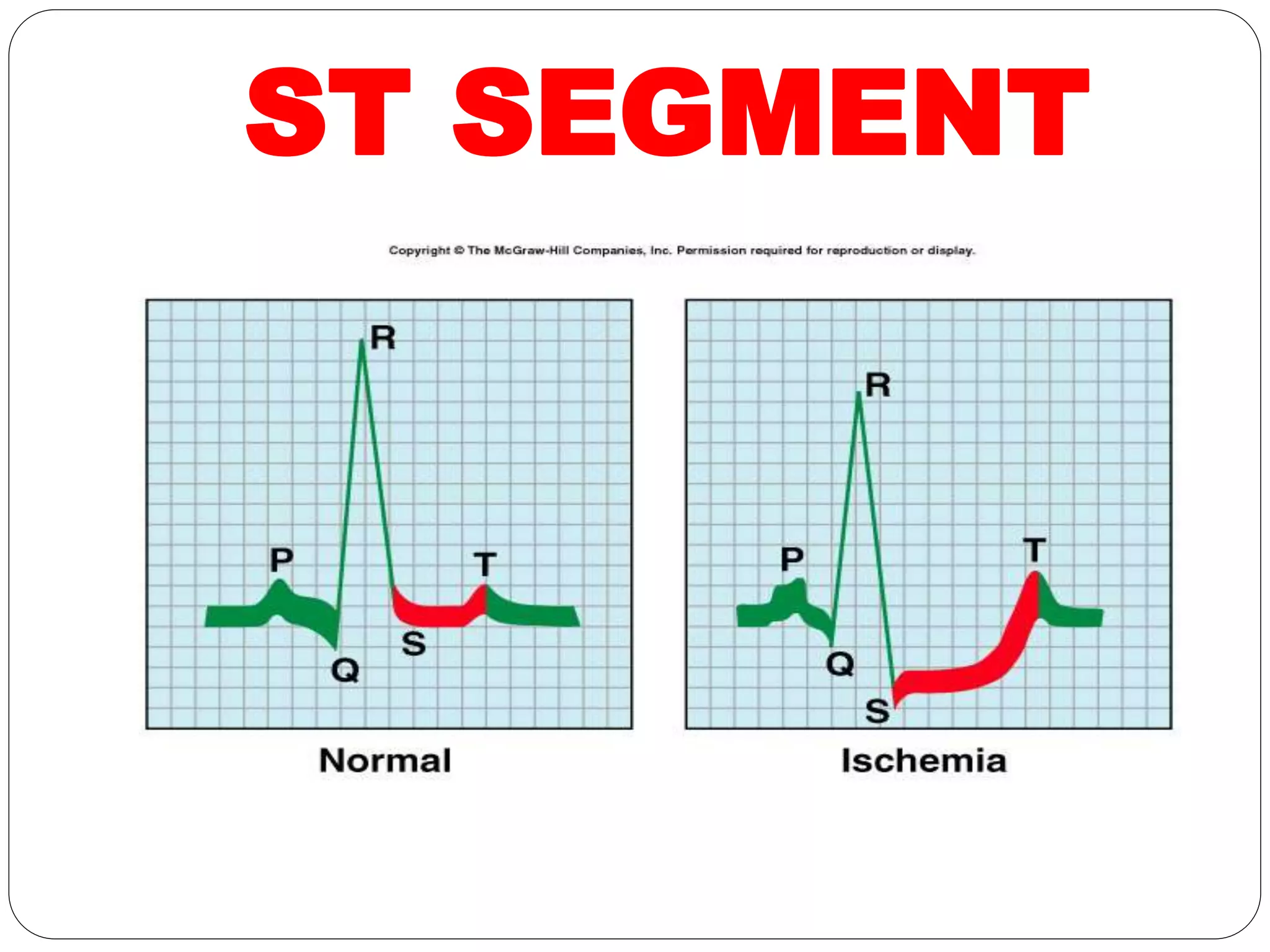 ECG Simple Approach.pptx