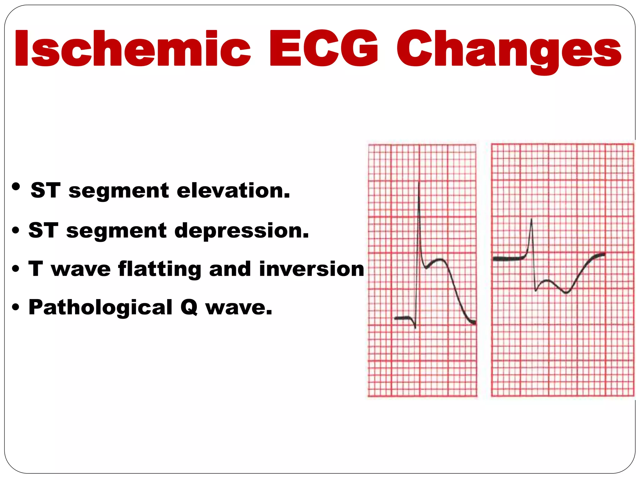 ECG Simple Approach.pptx