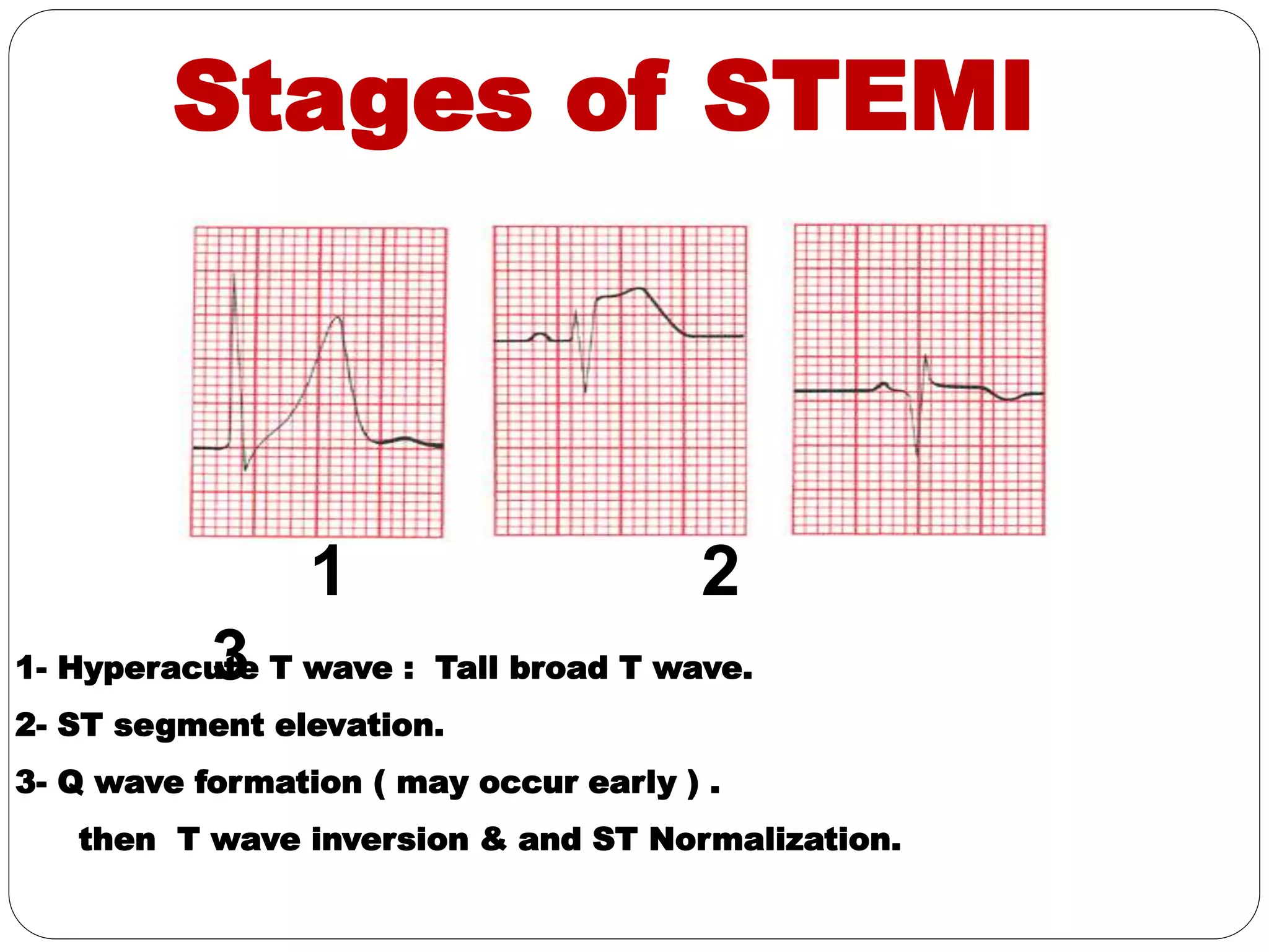 ECG Simple Approach.pptx