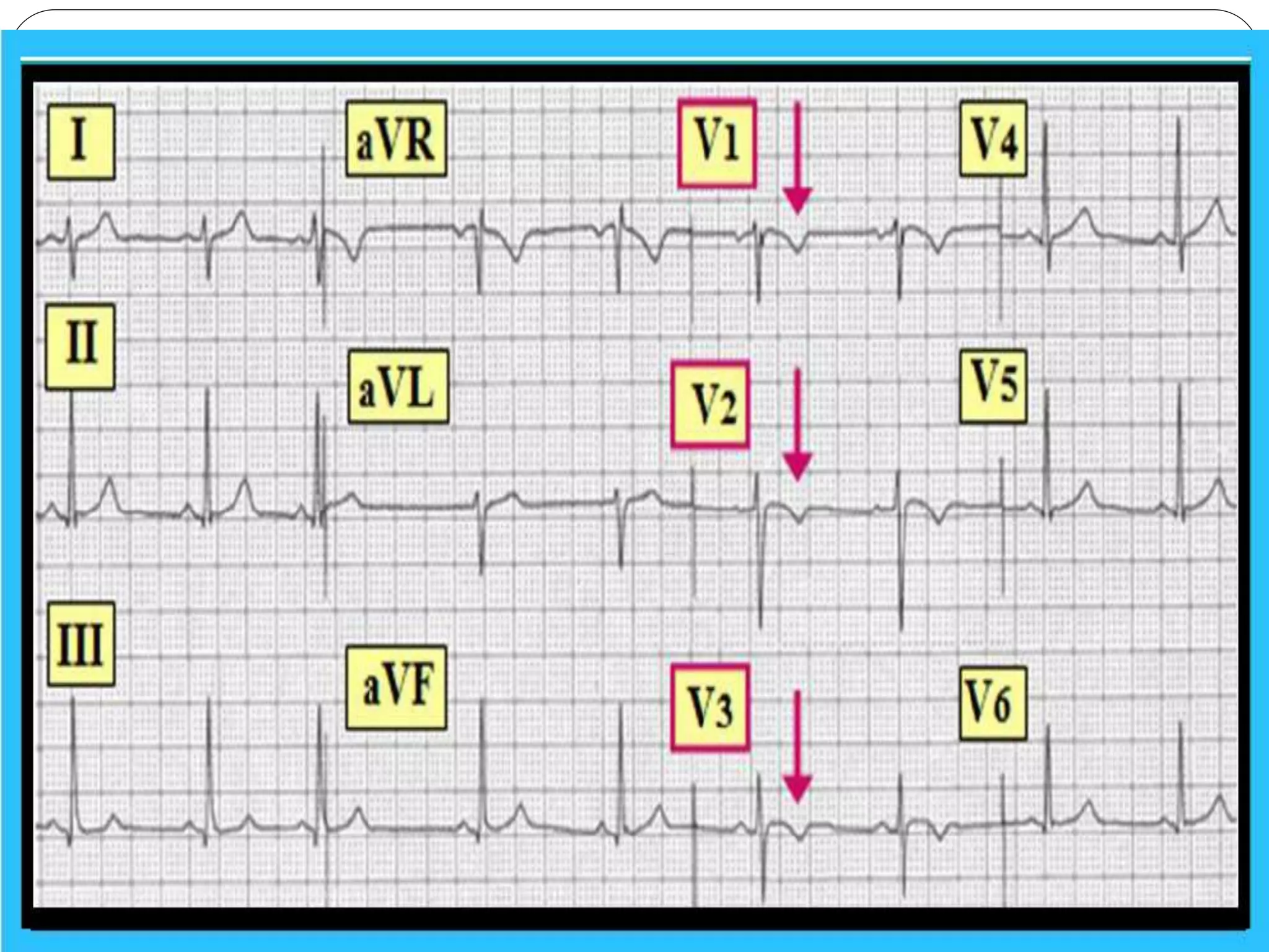 ECG Simple Approach.pptx