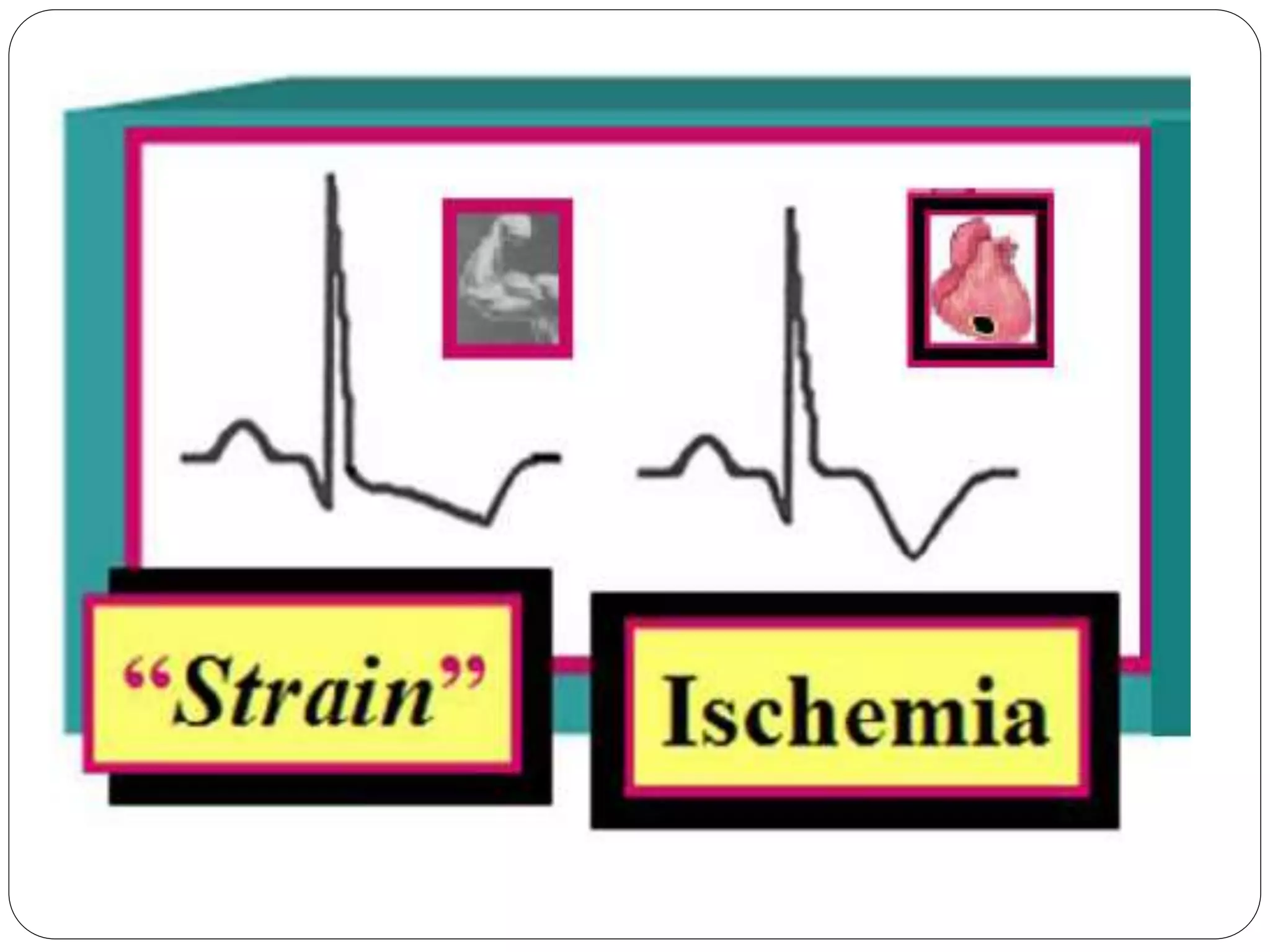 ECG Simple Approach.pptx