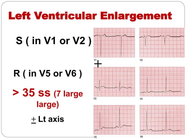 ECG Simple Approach.pptx