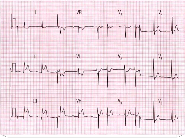 ECG Simple Approach.pptx