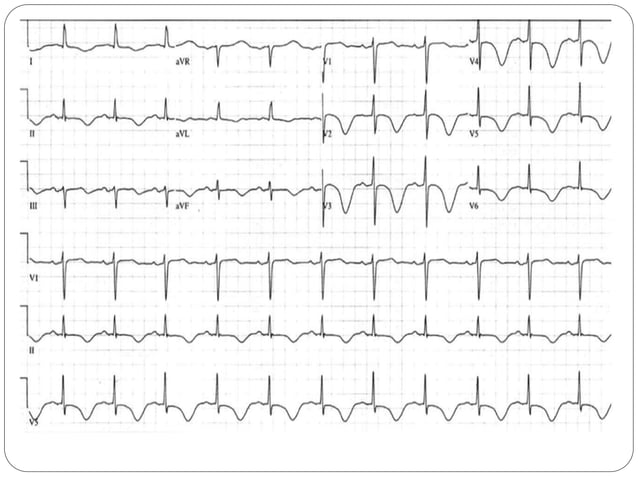 ECG Simple Approach.pptx