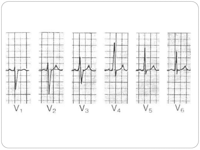 ECG Simple Approach.pptx