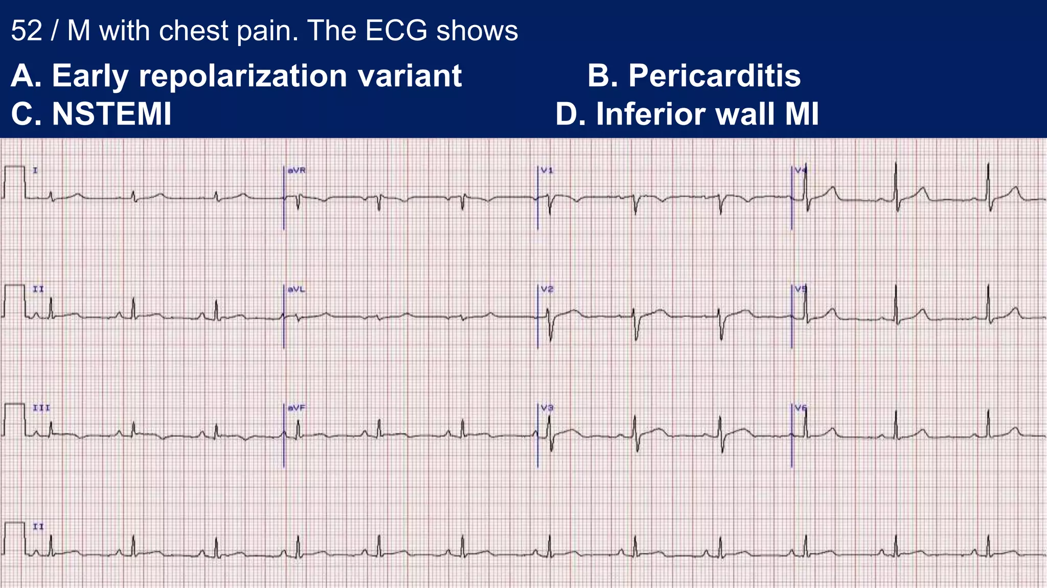 ECGs in Acute Coronary Syndrome | PPTX