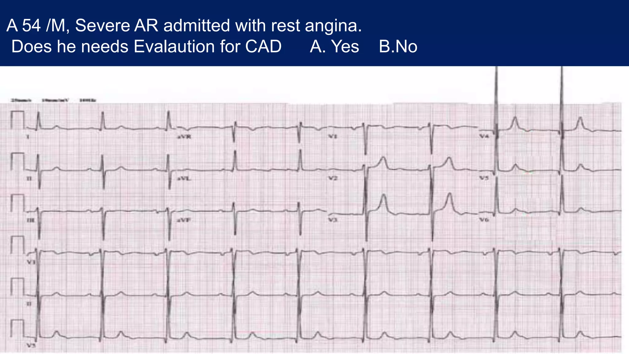 ECGs in Acute Coronary Syndrome | PPTX
