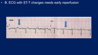 ECGs in Acute Coronary Syndrome | PPTX