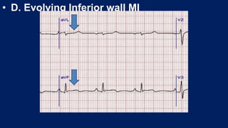 ECGs in Acute Coronary Syndrome | PPTX