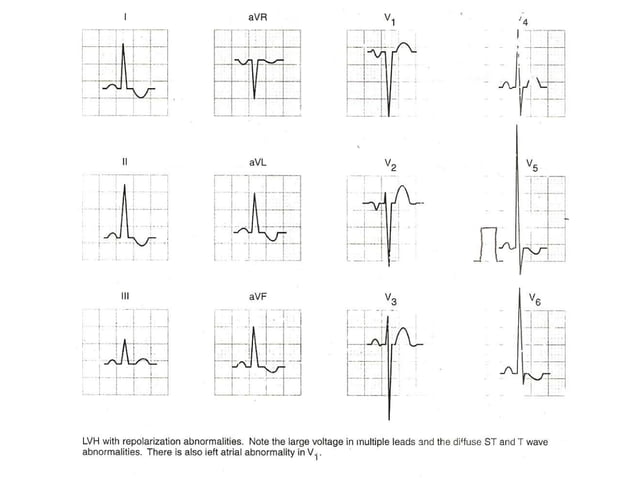 Ecg skills enhancement | PPT