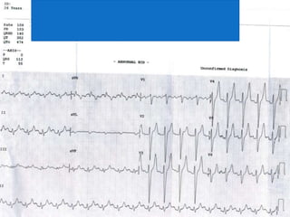 Ecgs of svt | PPTX