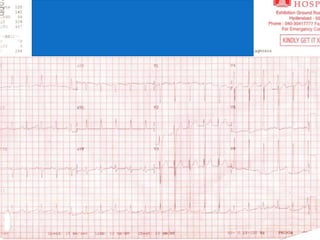 Ecgs of svt | PPTX