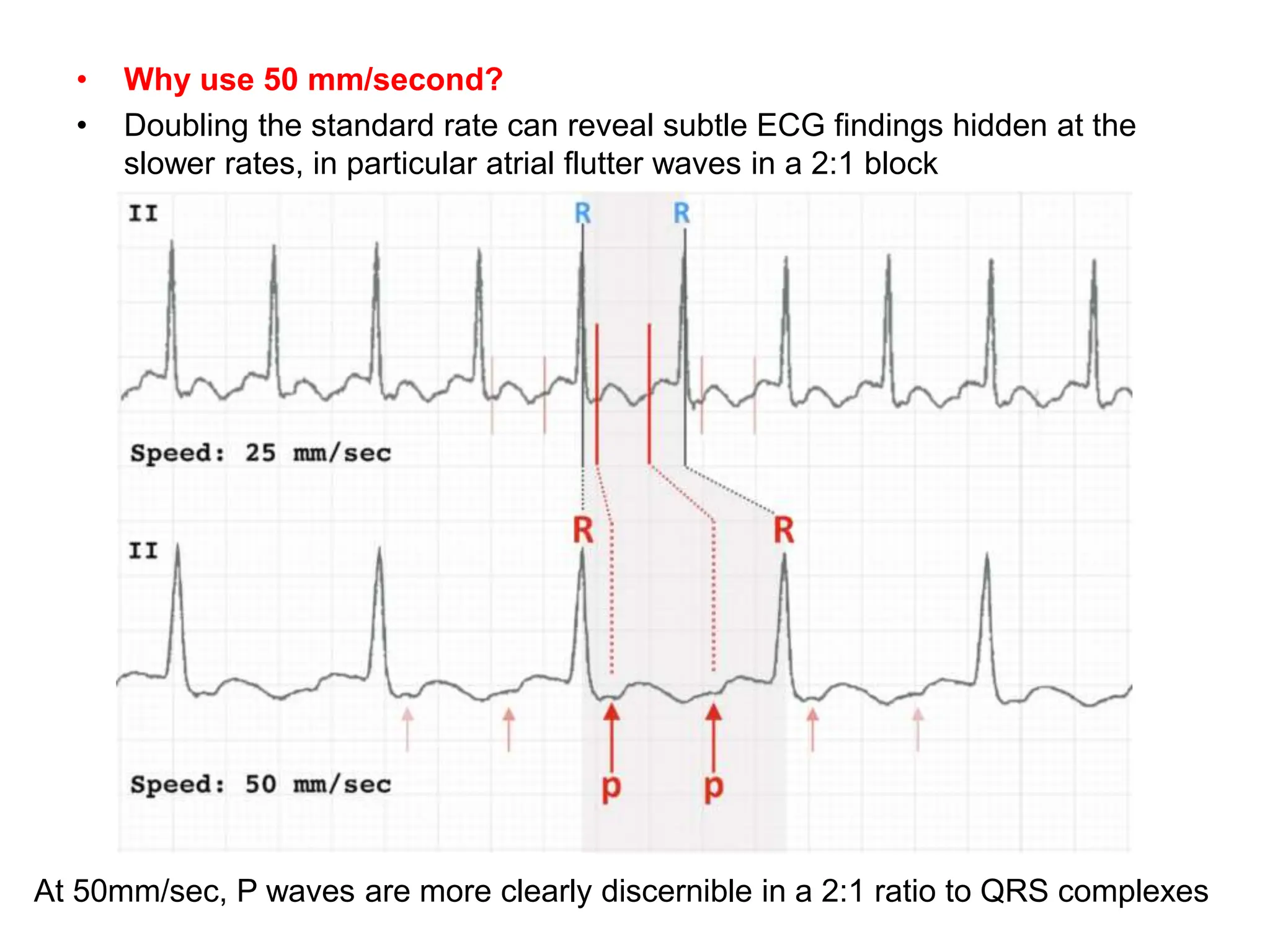 ECG STEPS,10 STEPS IN ECG INTERPRETATION | PPTX