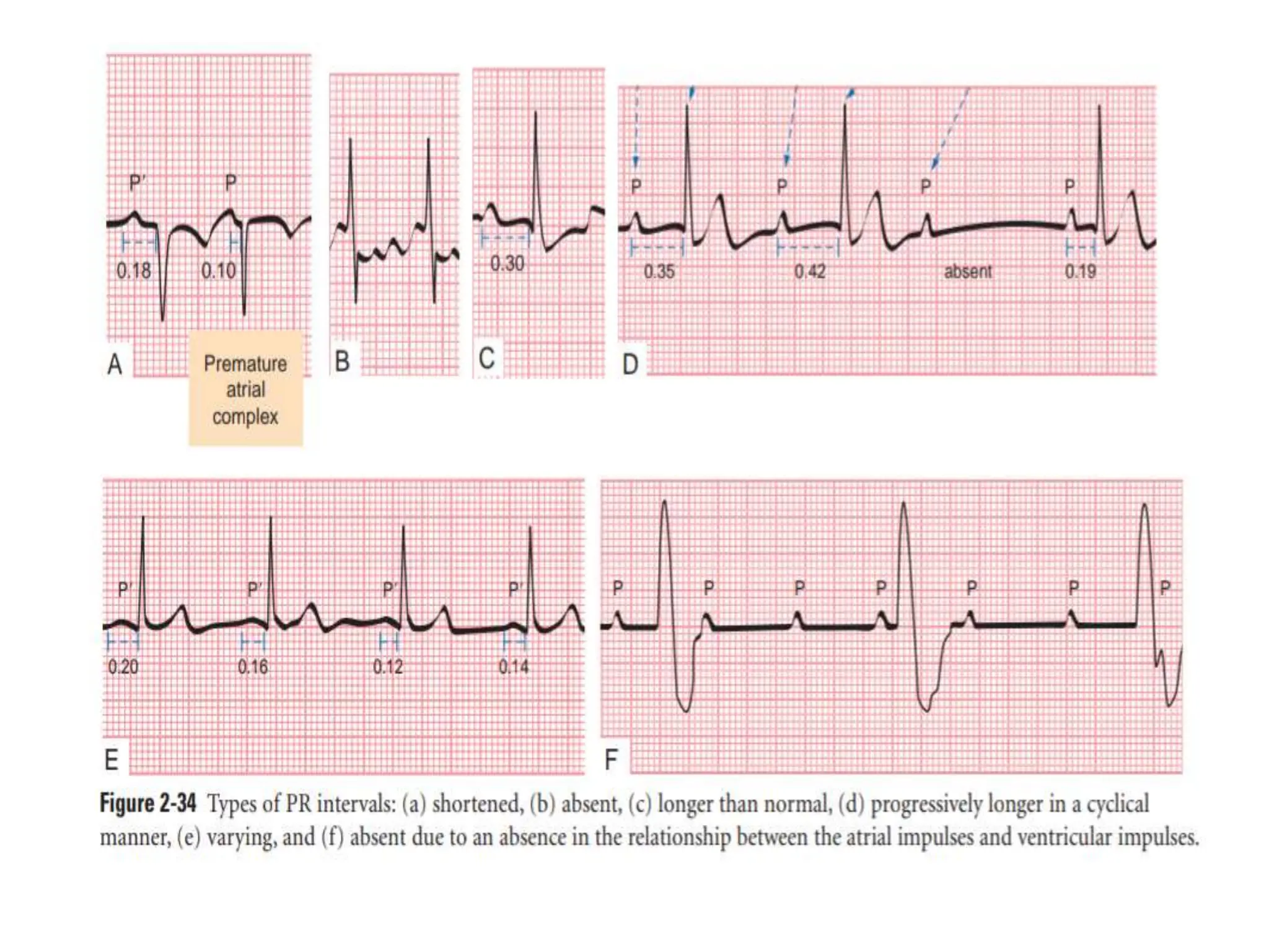 ECG STEPS,10 STEPS IN ECG INTERPRETATION | PPT