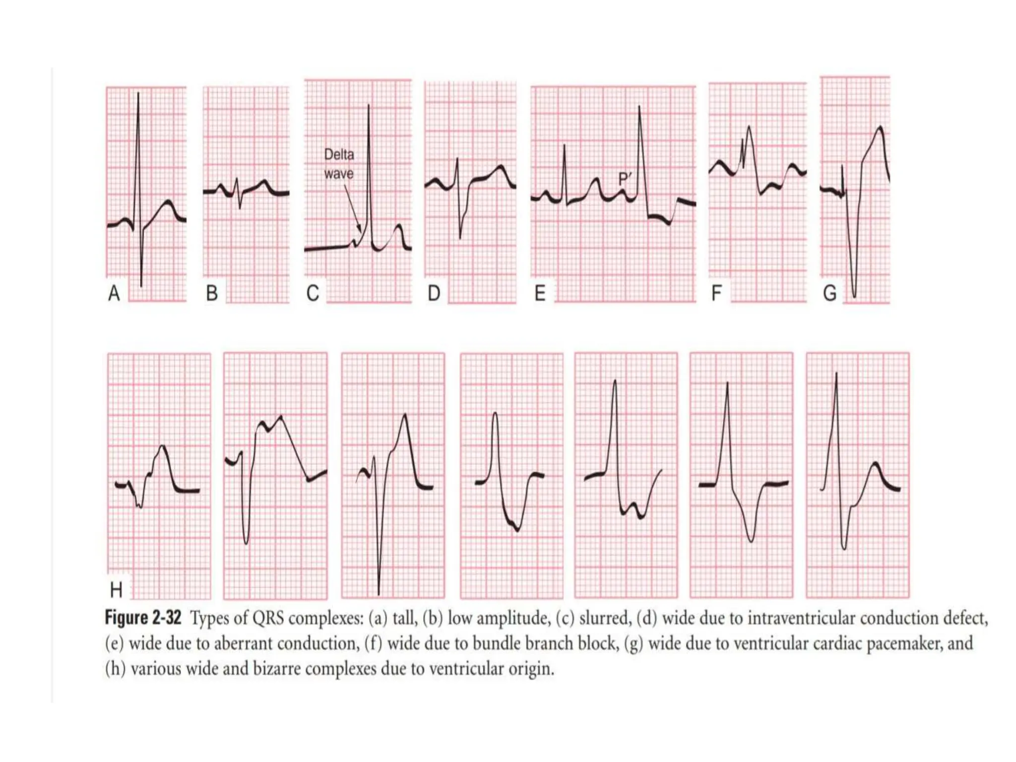 ECG STEPS,10 STEPS IN ECG INTERPRETATION | PPTX