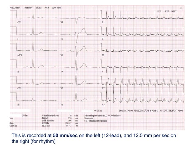 ECG STEPS,10 STEPS IN ECG INTERPRETATION | PPT