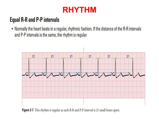 ECG STEPS,10 STEPS IN ECG INTERPRETATION | PPT