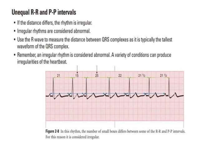 ECG STEPS,10 STEPS IN ECG INTERPRETATION | PPT