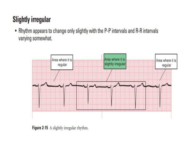 ECG STEPS,10 STEPS IN ECG INTERPRETATION | PPTX | Heart and ...