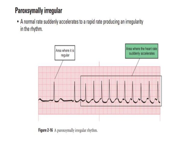 ECG STEPS,10 STEPS IN ECG INTERPRETATION | PPTX | Heart and ...