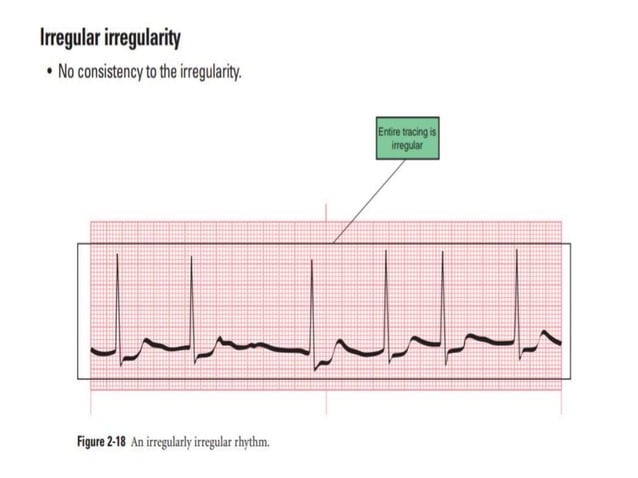 ECG STEPS,10 STEPS IN ECG INTERPRETATION | PPTX | Heart and ...