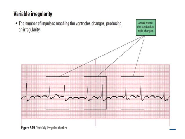 ECG STEPS,10 STEPS IN ECG INTERPRETATION | PPTX | Heart and ...