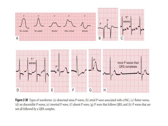 ECG STEPS,10 STEPS IN ECG INTERPRETATION | PPTX | Heart and ...