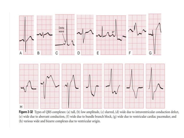 ECG STEPS,10 STEPS IN ECG INTERPRETATION | PPTX | Heart and ...
