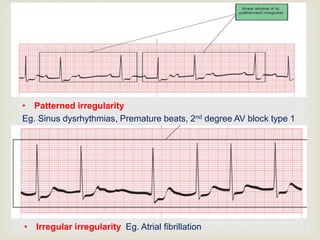 ECG STEPS AND ITS INTERPRETATION - Copy.pptx