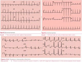 ECG STEPS AND ITS INTERPRETATION - Copy.pptx