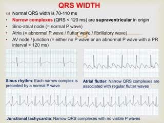 ECG STEPS AND ITS INTERPRETATION - Copy.pptx