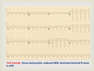 ECG STEPS AND ITS INTERPRETATION - Copy.pptx