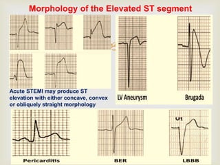 ECG STEPS AND ITS INTERPRETATION - Copy.pptx