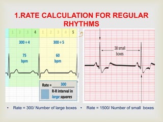 ECG STEPS AND ITS INTERPRETATION - Copy.pptx