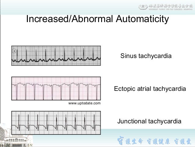 Arrhythmia: ECG-Tachycardia_20120909_中區