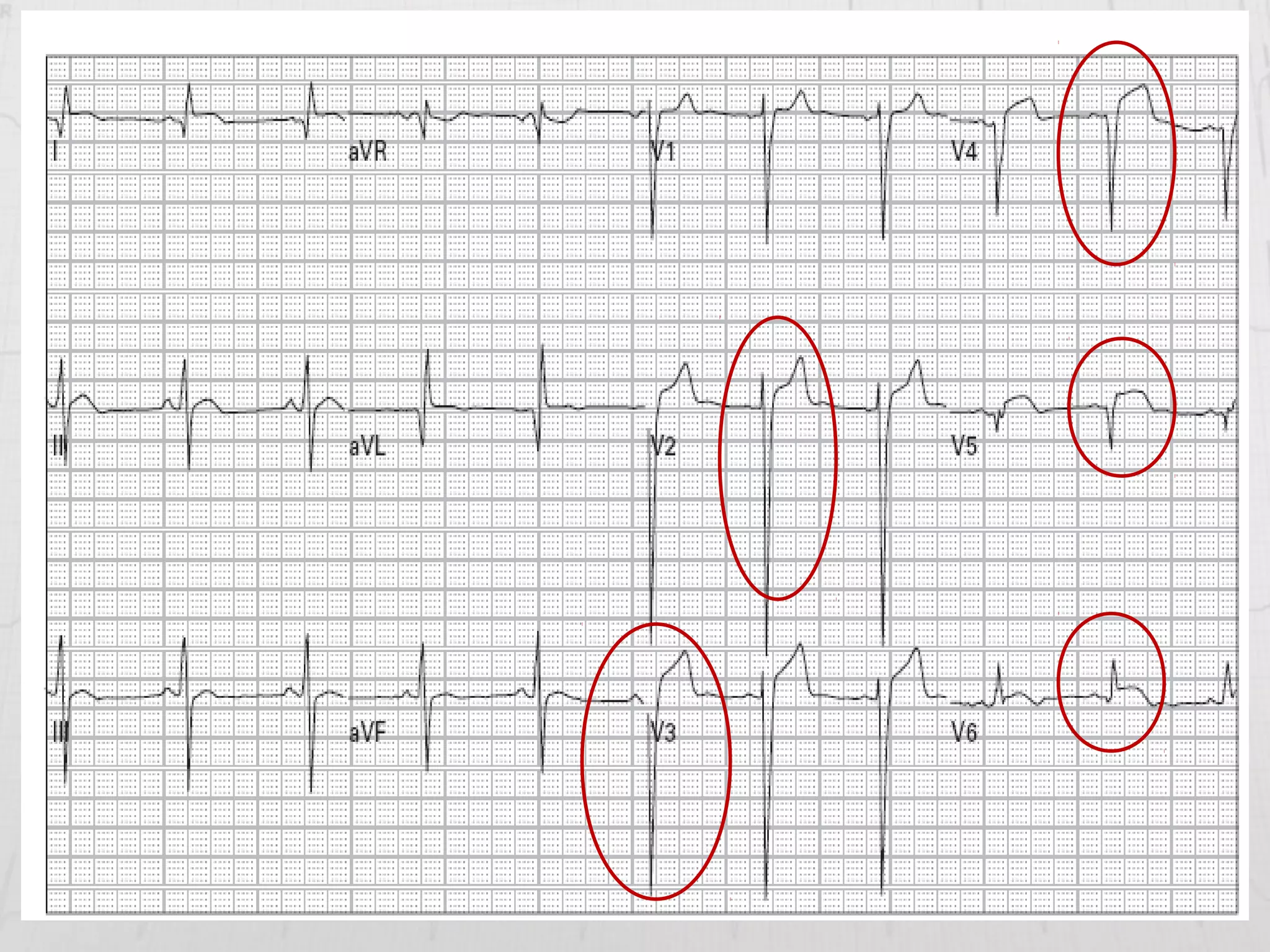 Geraldine Leong - ECG for paramedics | PPT
